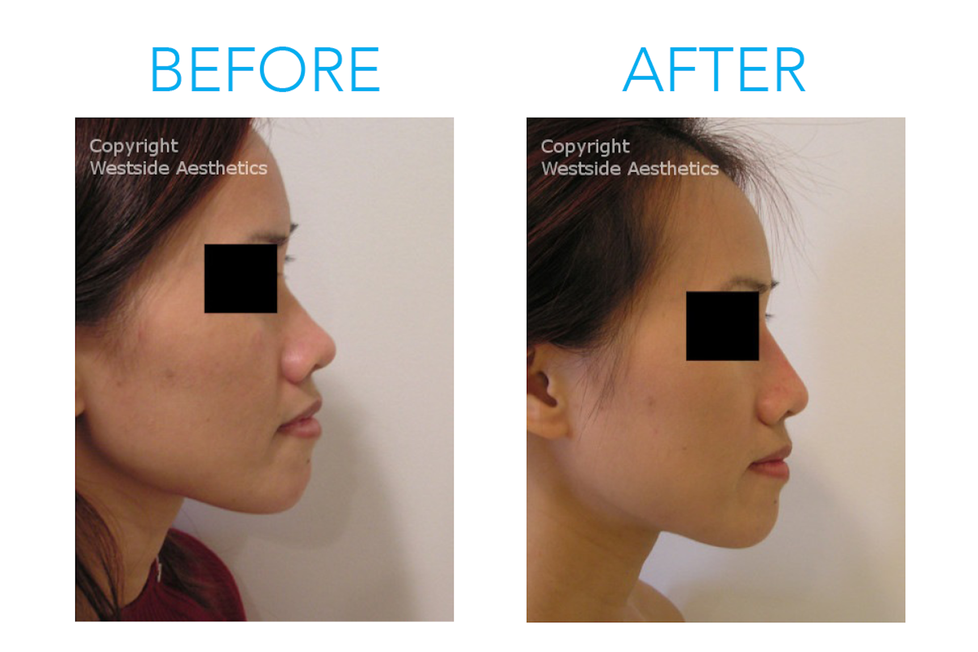 The Non-Surgical Nose Job