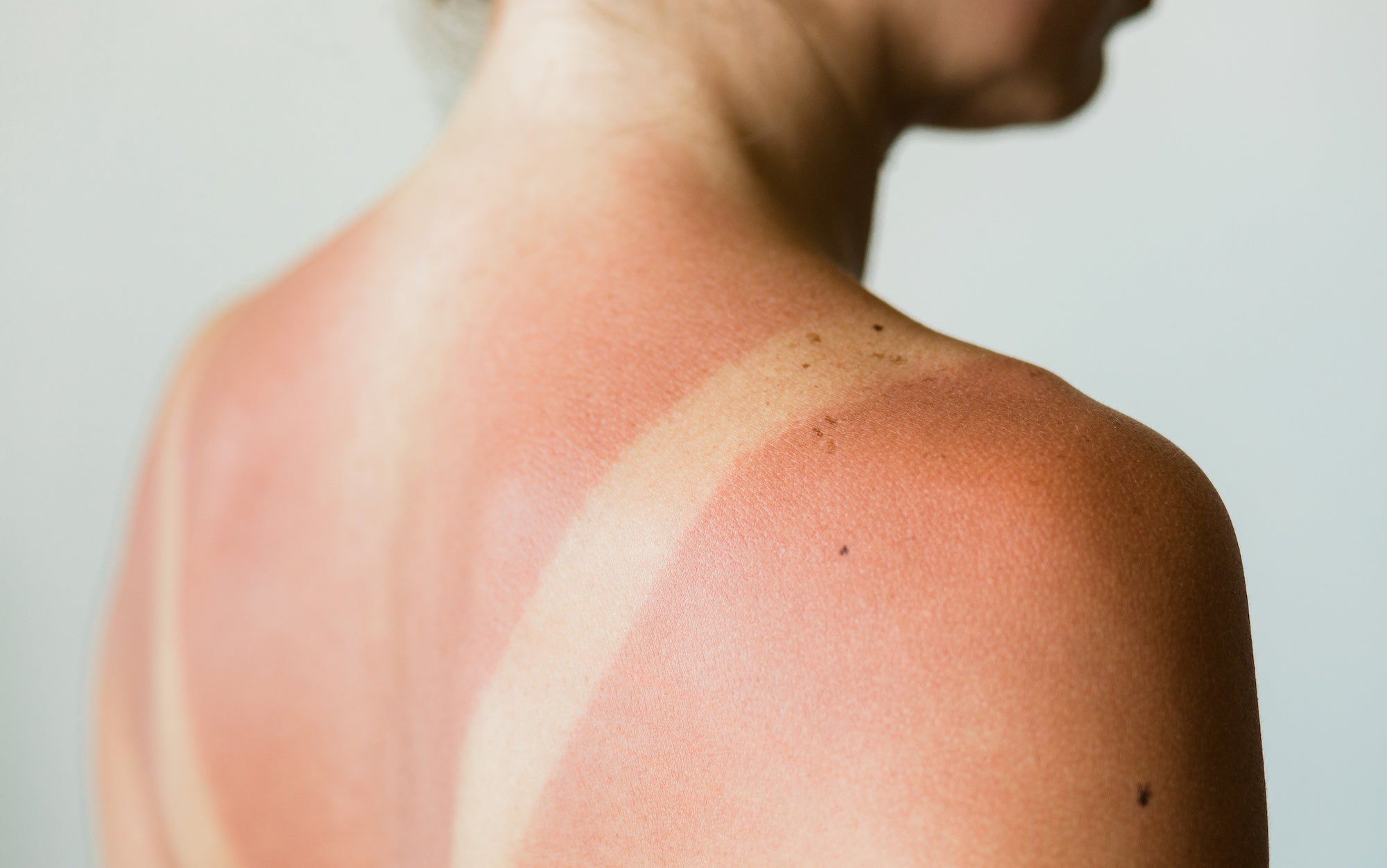 So You Forgot Sunscreen? Here's What Dermatologists Recommend to Ease